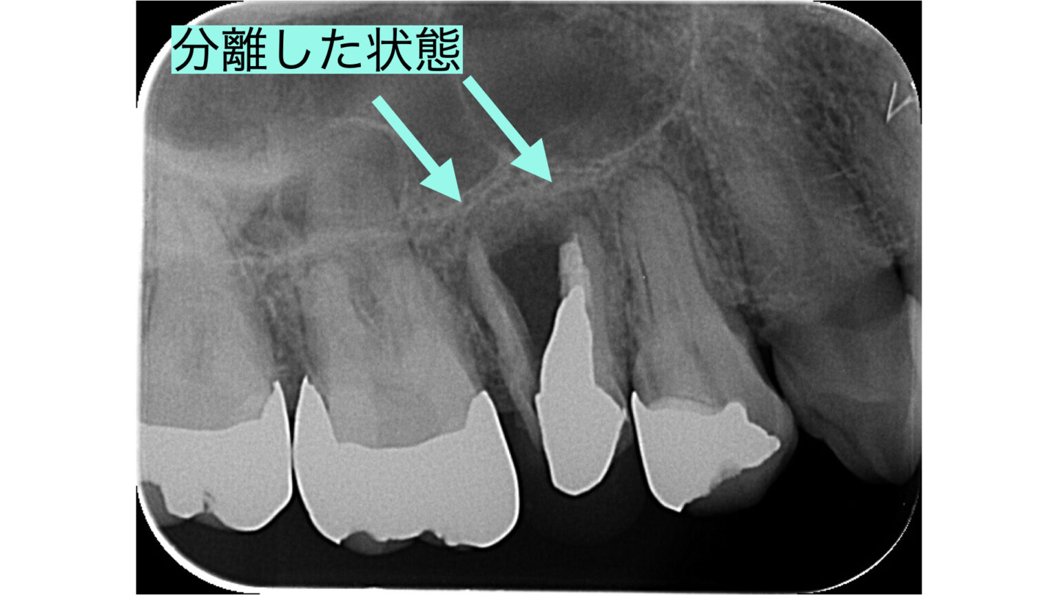 歯が割れる？ー歯根の垂直破折（VRF） | 愛歯科医院